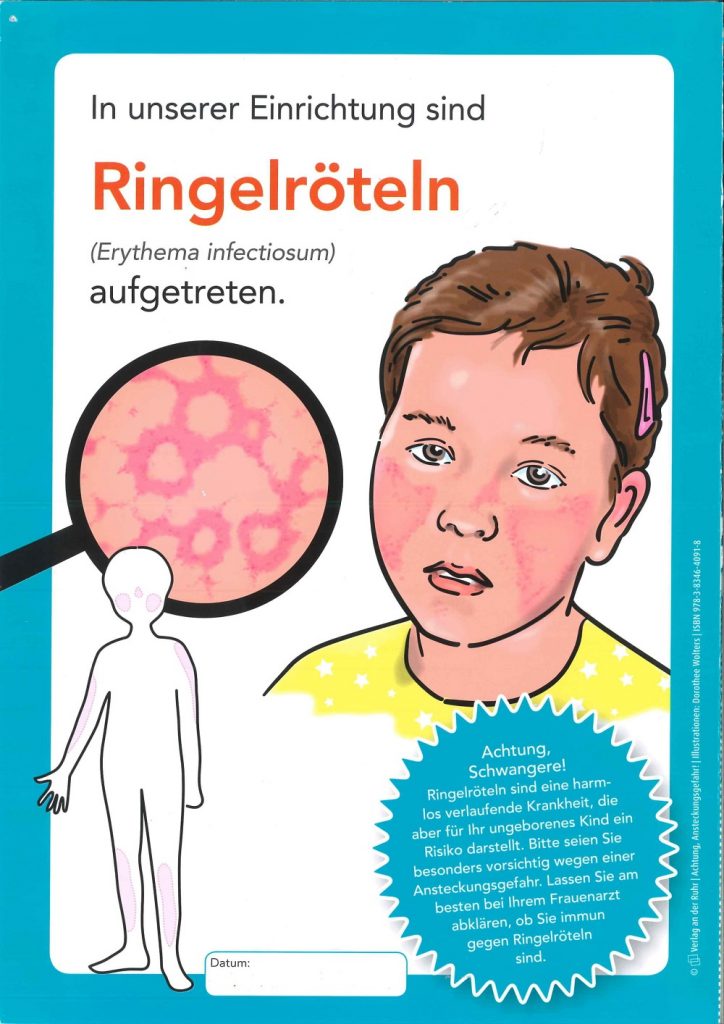 In unserer Einrichtung sind Ringelröteln aufgetreten
